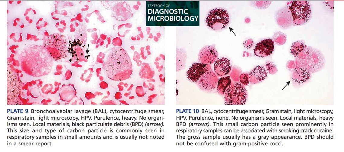 نمای میکروسکوپی از لام مستقیم نمونه BAL سیتوسانتریفیوژ شده - آزمایشگاه ...