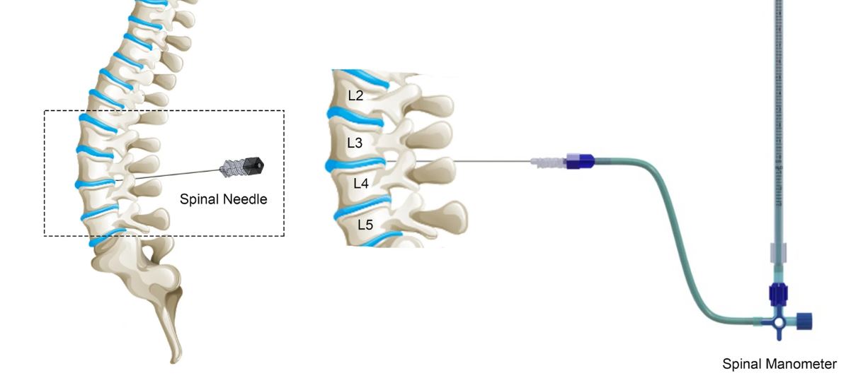 اندازه گیری مانومتر نخاعی در زمان نمونه گیری CSF - آزمایشگاه مجازی ...