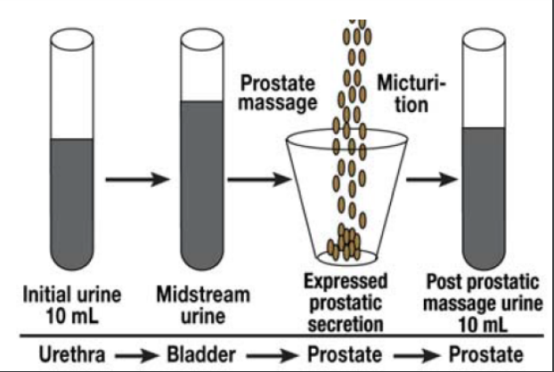تست چهار لیوانی ميرز– استامي (Meares-Stamey four-glass test) برای نمونه ...